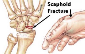 Anatomical Snuff Box | Healthooze